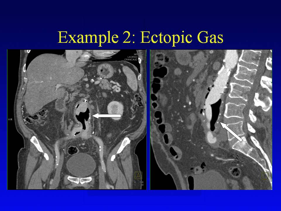 Gastrointestinal - Learning Modules - CTisus.com CT Scanning