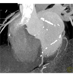 Extensive Left Anterior Descending Coronary Artery (LAD) Disease ...