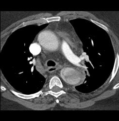 Type B Dissection - Chest Radiology Case Studies - CTisus CT Scanning