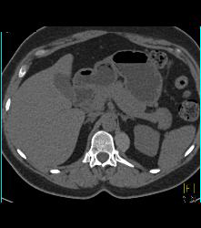 Bronchogenic Cyst Presents as Mass Off Diaphragm - Chest Case Studies ...