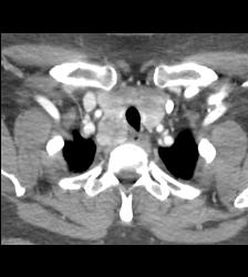 Goiter With Substernal Extension - Chest Radiology Case Studies ...