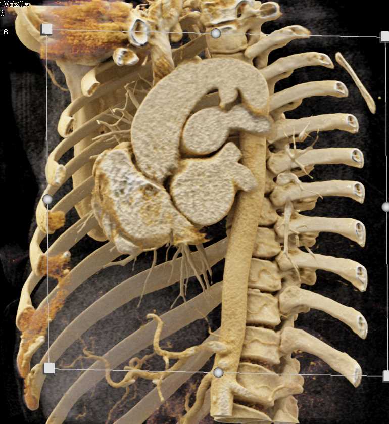 Patent Ductus Arteriosus Pda With Ductus Bump Seen On 3d Sagittal