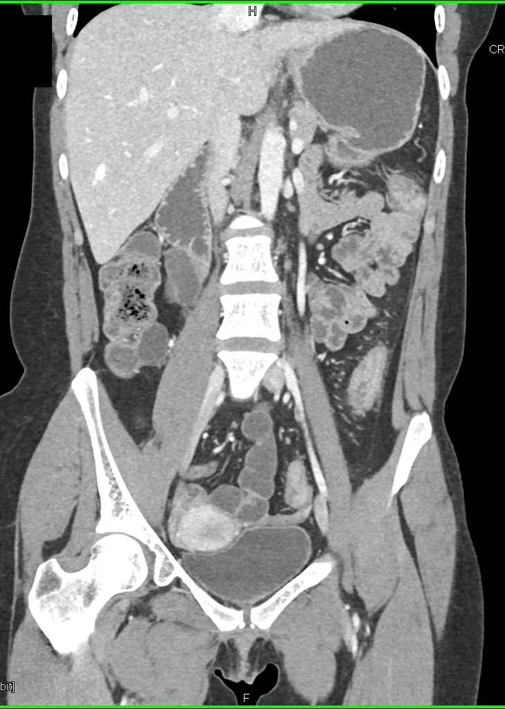 Ulcerative Colitis Involves the Sigmoid Colon - Colon Radiology Case ...
