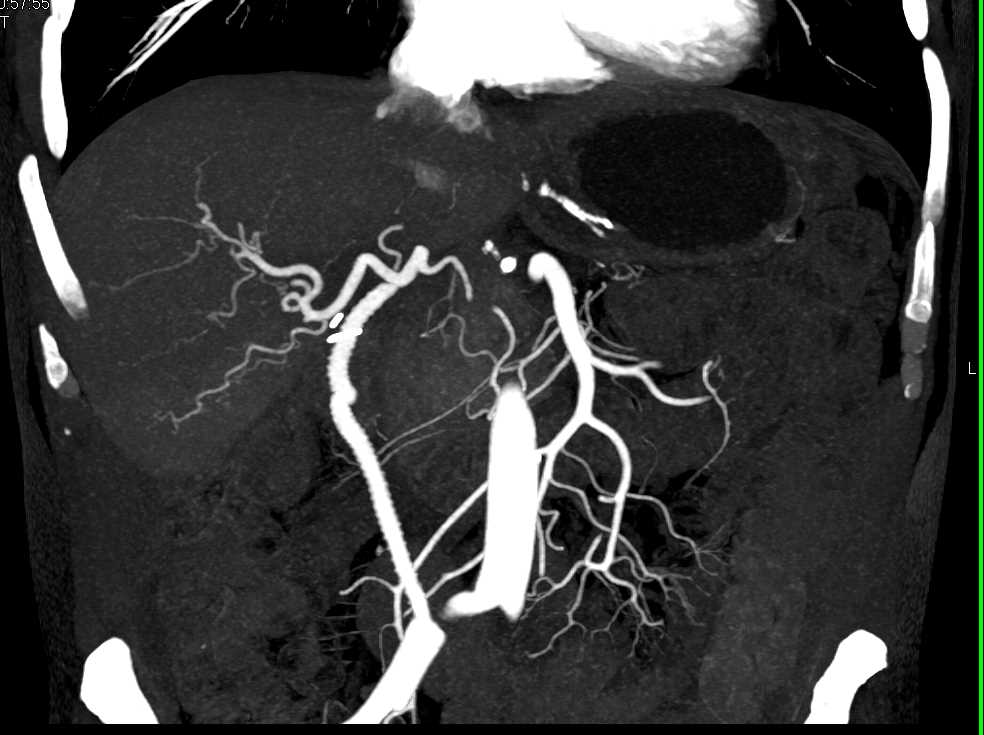 CTPV with Bypass Grafts - Liver Radiology Case Studies - CTisus CT Scanning