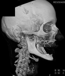 Base of Skull - Musculoskeletal Case Studies - CTisus CT Scanning