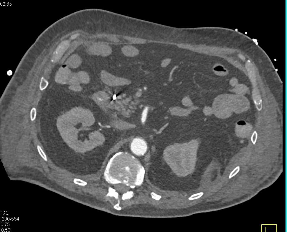 Hematoma Left Flank - Musculoskeletal Radiology Case Studies - CTisus ...