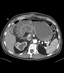 Post Whipple Procedure With Delayed Gastric Emptying - Pancreas ...
