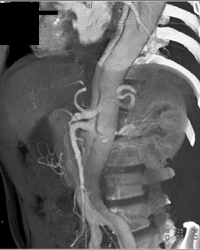Type B Dissection - Vascular Radiology Case Studies - CTisus CT Scanning