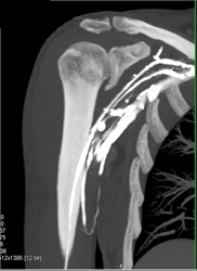 Stab Wound of Axilla Without Vascular Injury With Multiple Renderings ...
