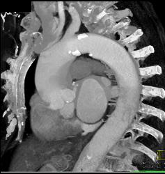 Dilated Aortic Root With Valve Calcifications - Vascular Case Studies ...