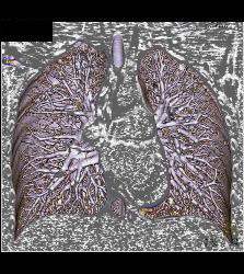 Pulmonary Arteriovenous Malformation (PAVM) in Patient With Hereditary ...