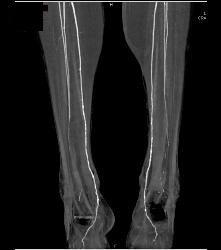 Runoff Study With Mild Peripheral Vascular Disease (PVD) - Vascular ...