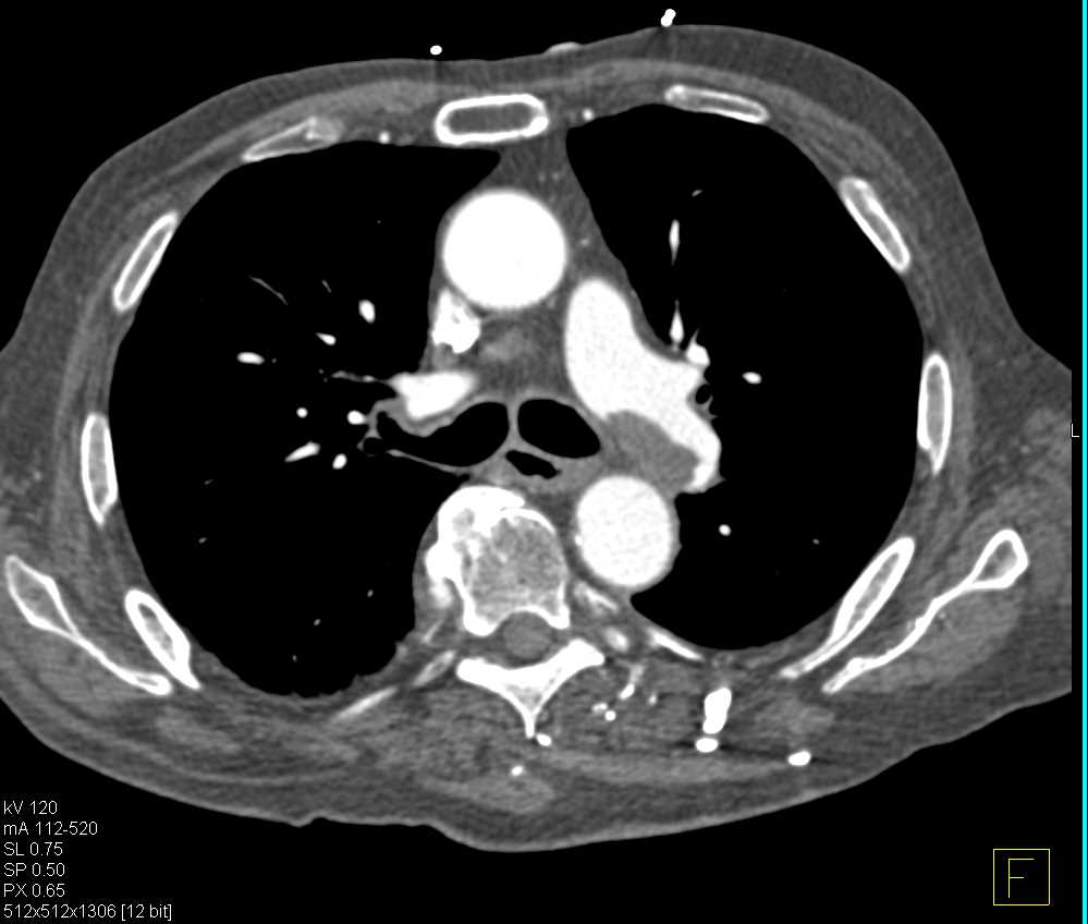 Pulmonary Emboli and Clot in Aorta - Vascular Radiology Case Studies ...