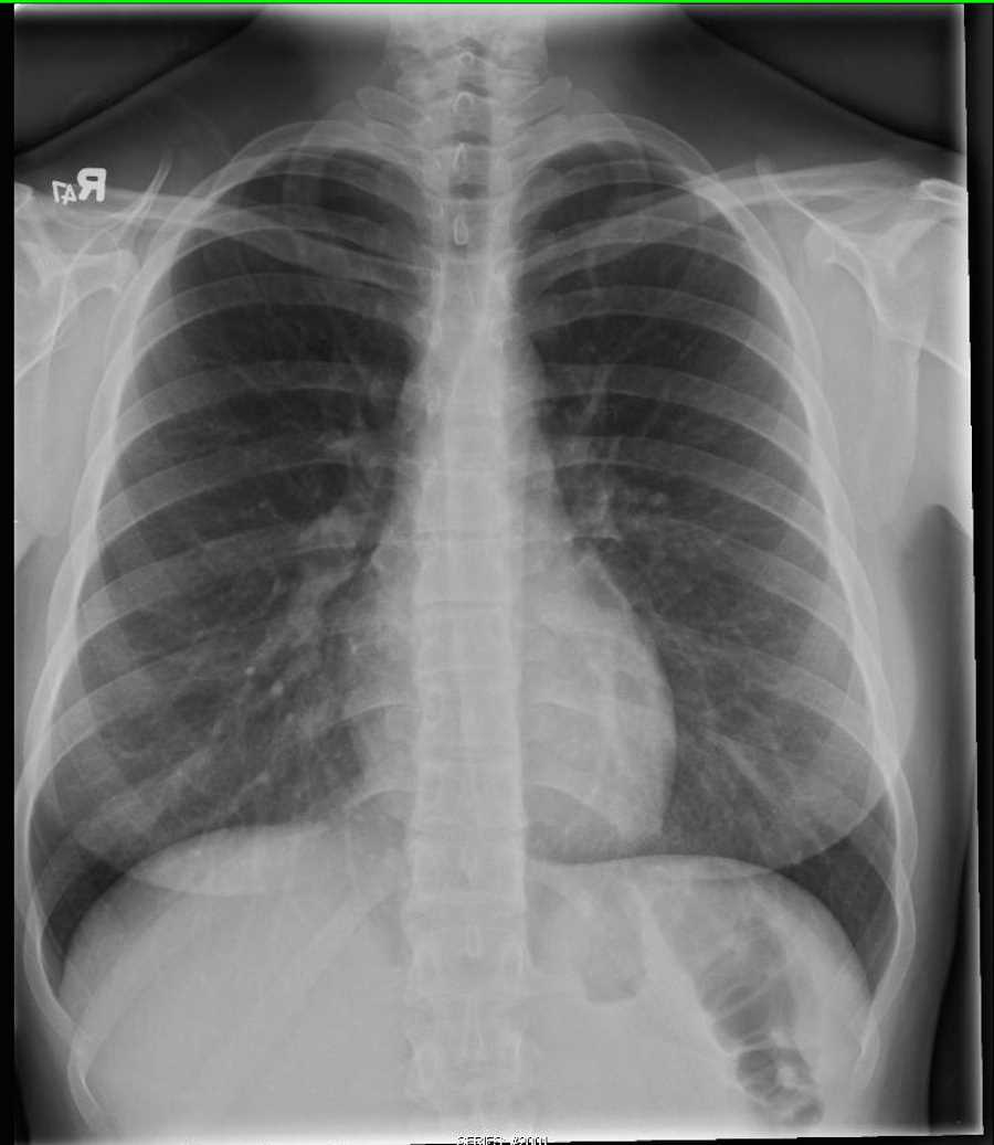 Normal Chest X ray X Rays Case Studies CTisus CT Scanning Normal Chest X ray X Rays Case Studies CTisus CT Scanning